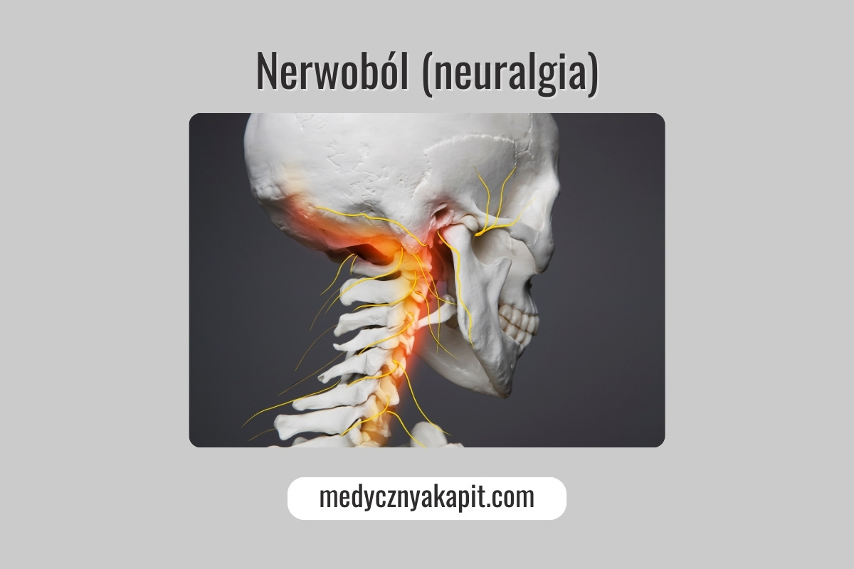 Czym są nerwobóle? Objawy i przyczyny – Medyczny Akapit