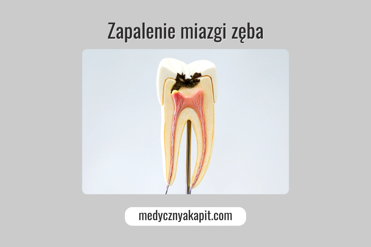Czym jest zapalenie miazgi zęba? Objawy i leczenie | Medyczny Akapit BLOG